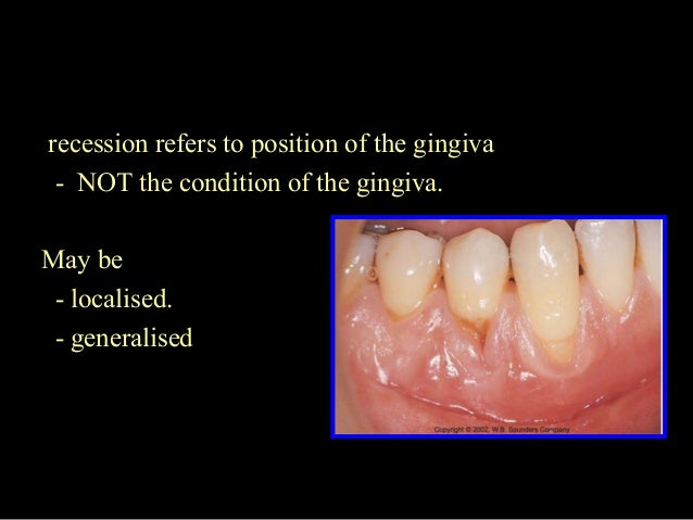 Clinical features ofgingivitis. periodontics