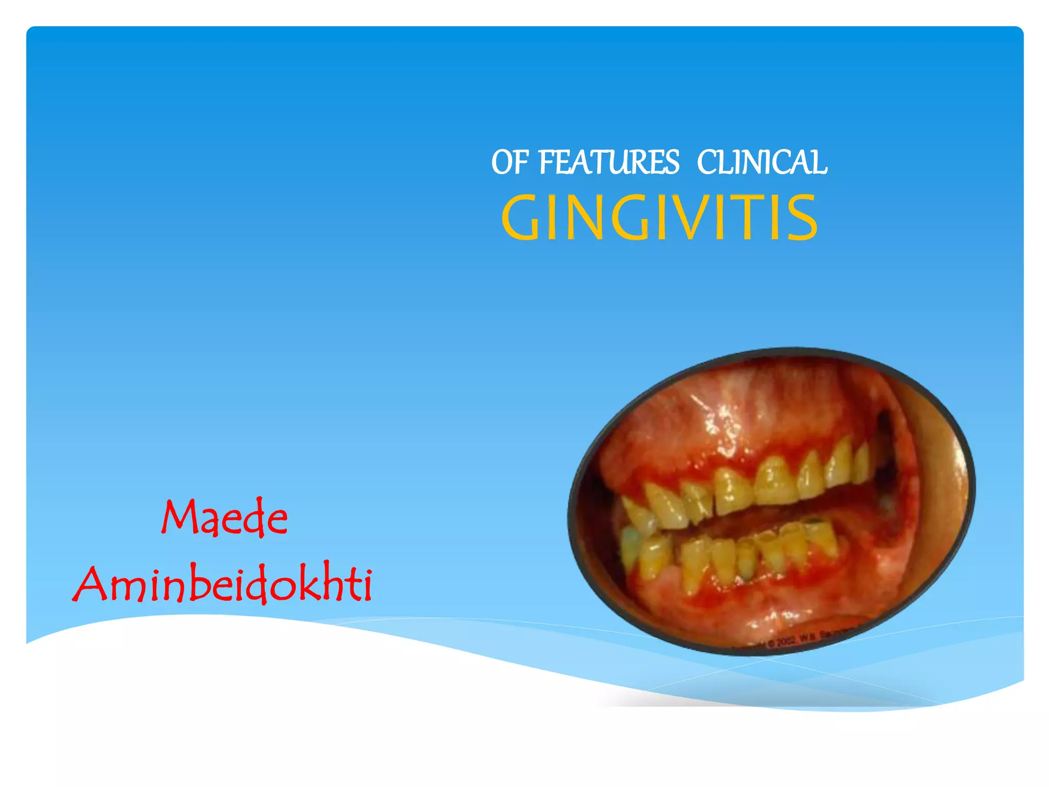 Clinical features of gingivitis | PPTX