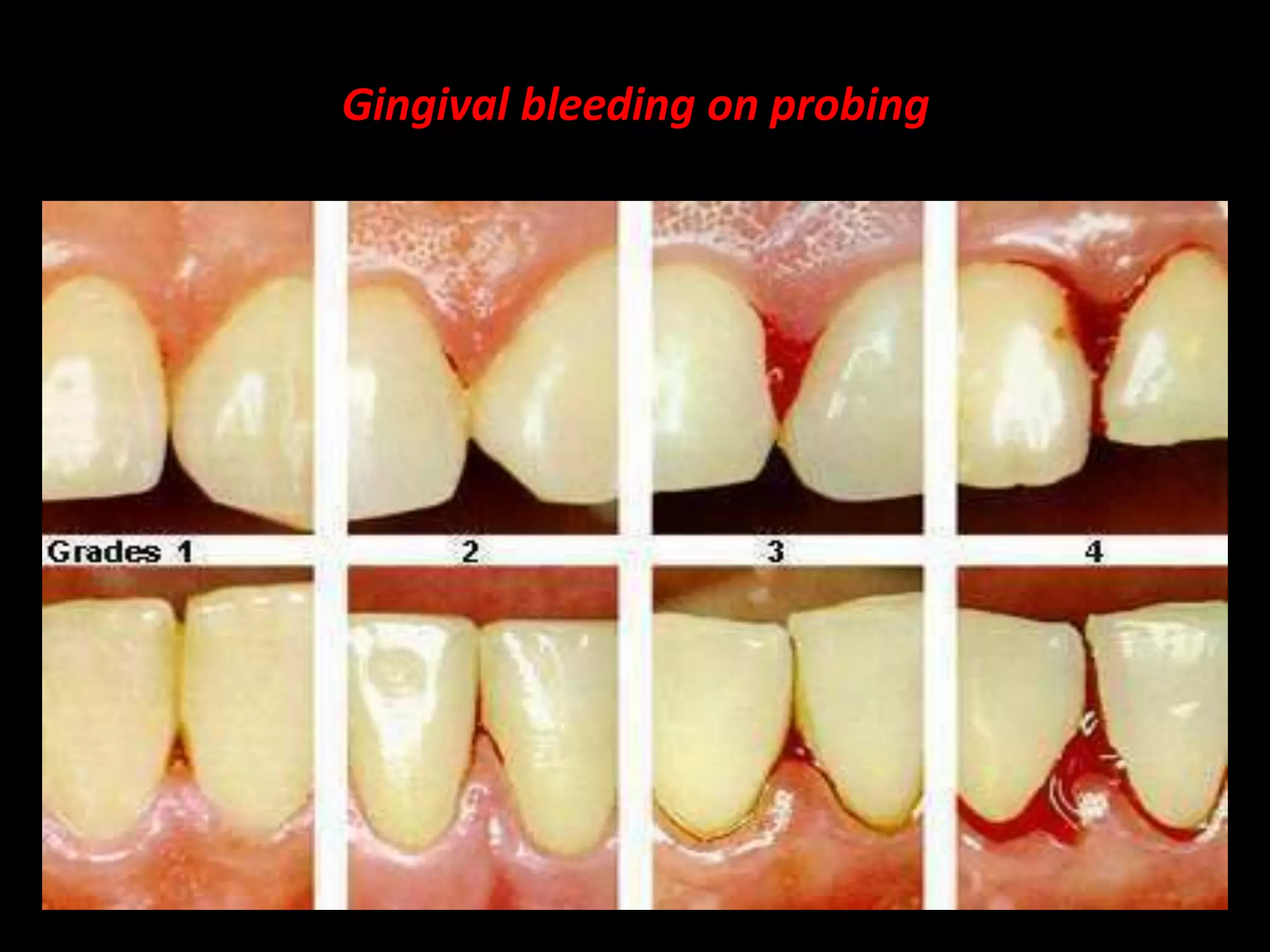 Clinical features of gingivitis | PPTX