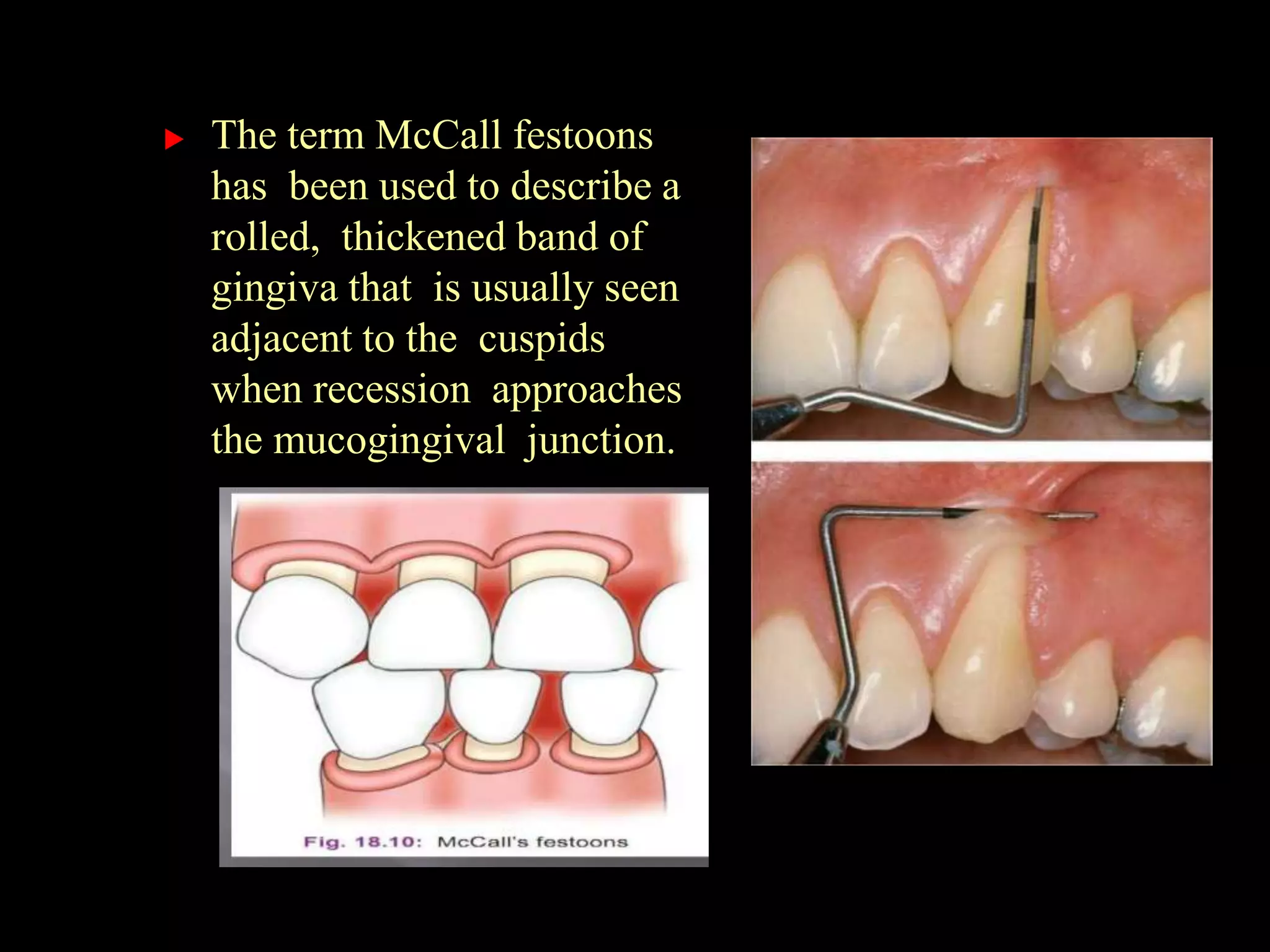 Clinical features of gingivitis | PPTX