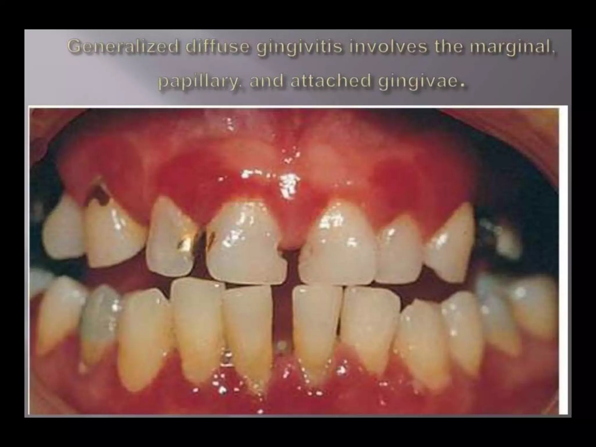 Clinical features of gingivitis | PPTX