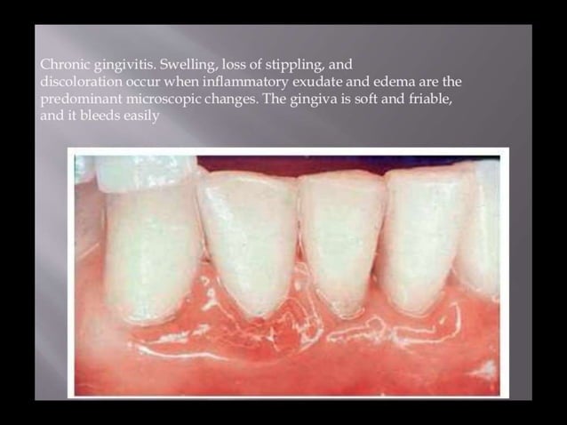 Clinical features of gingivitis | PPTX