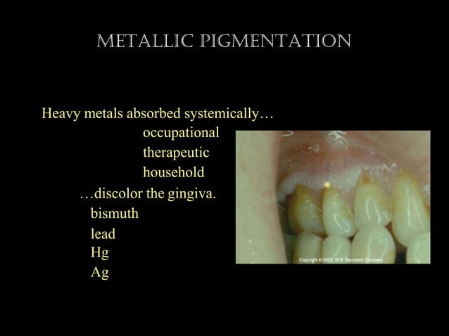 Clinical features of gingivitis | PPTX