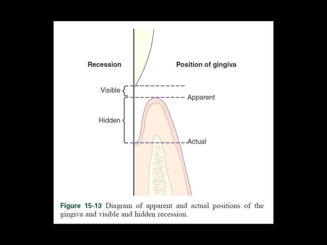 Clinical features of gingivitis | PPTX