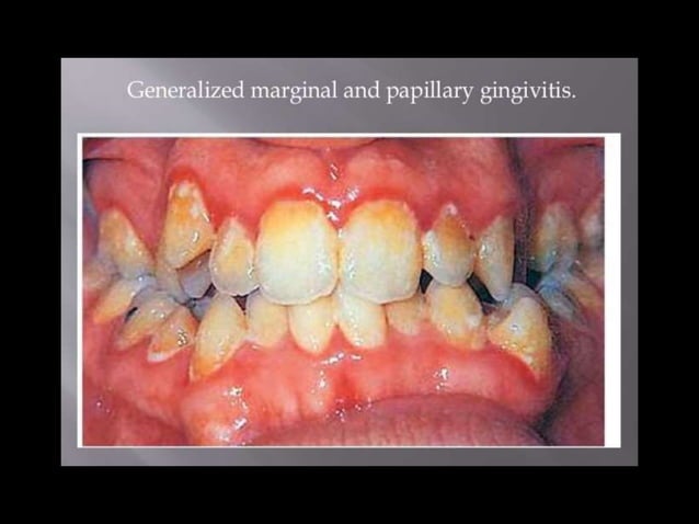 Clinical features of gingivitis | PPTX