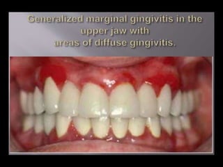 Clinical features of gingivitis | PPTX
