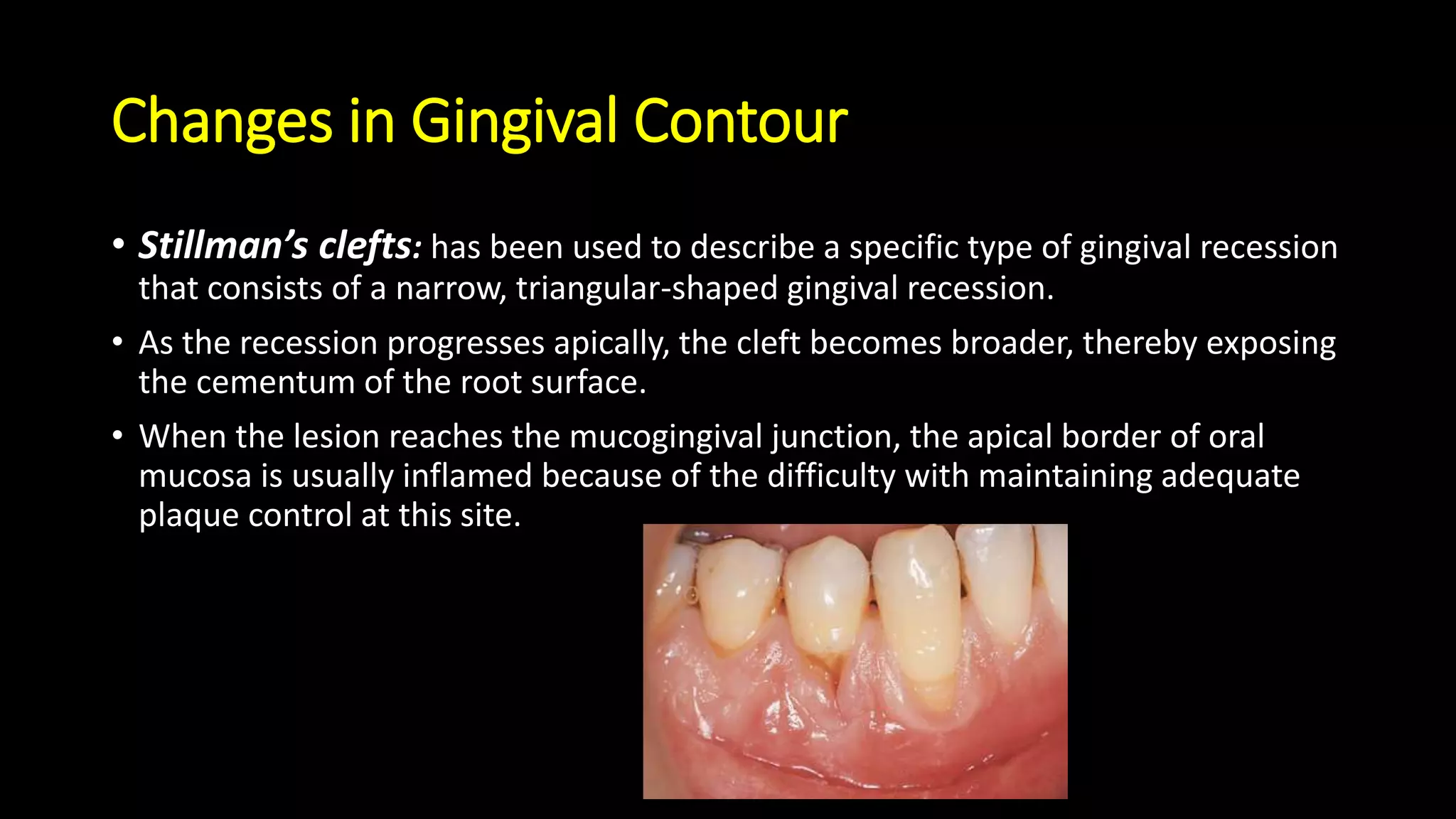 Clinical features of gingivitis | PPTX