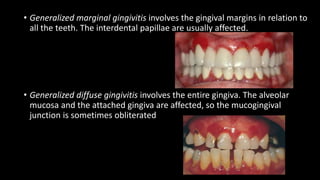 Clinical features of gingivitis | PPTX