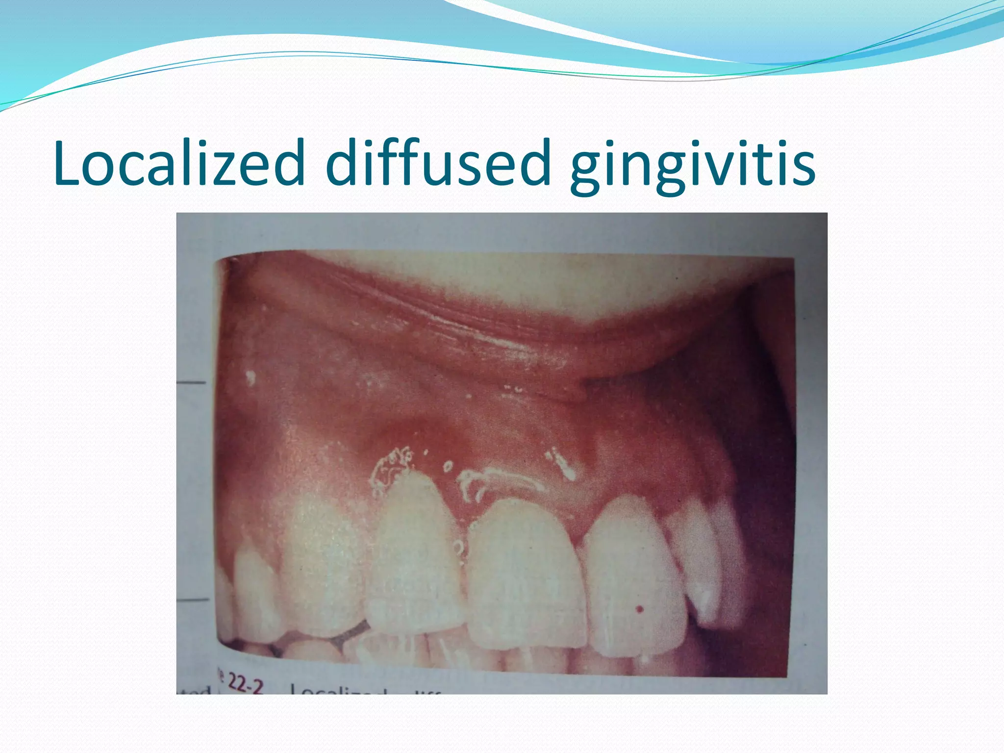 clinical features of gingivitis.pdf