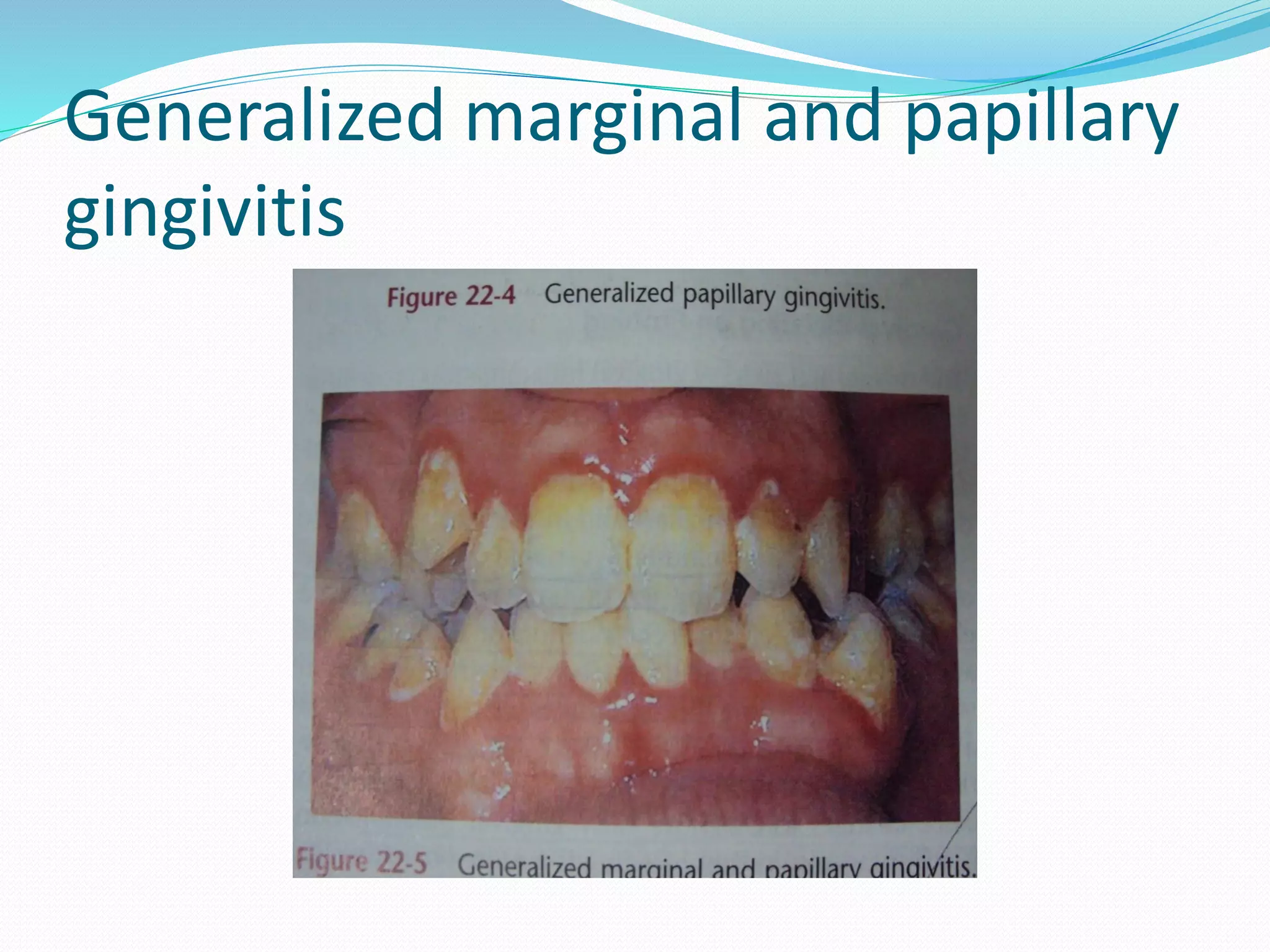 clinical features of gingivitis.pdf