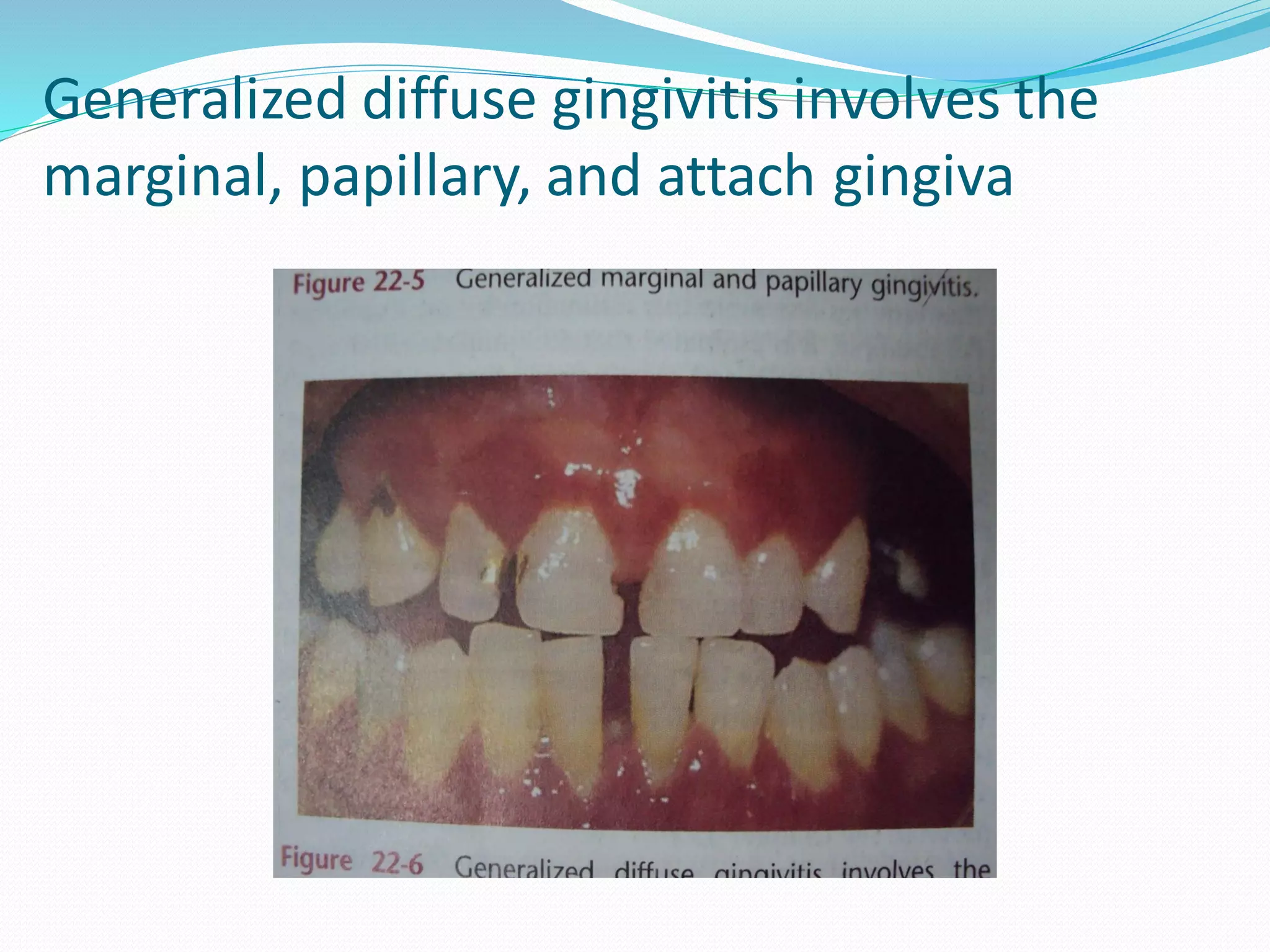 clinical features of gingivitis.pdf