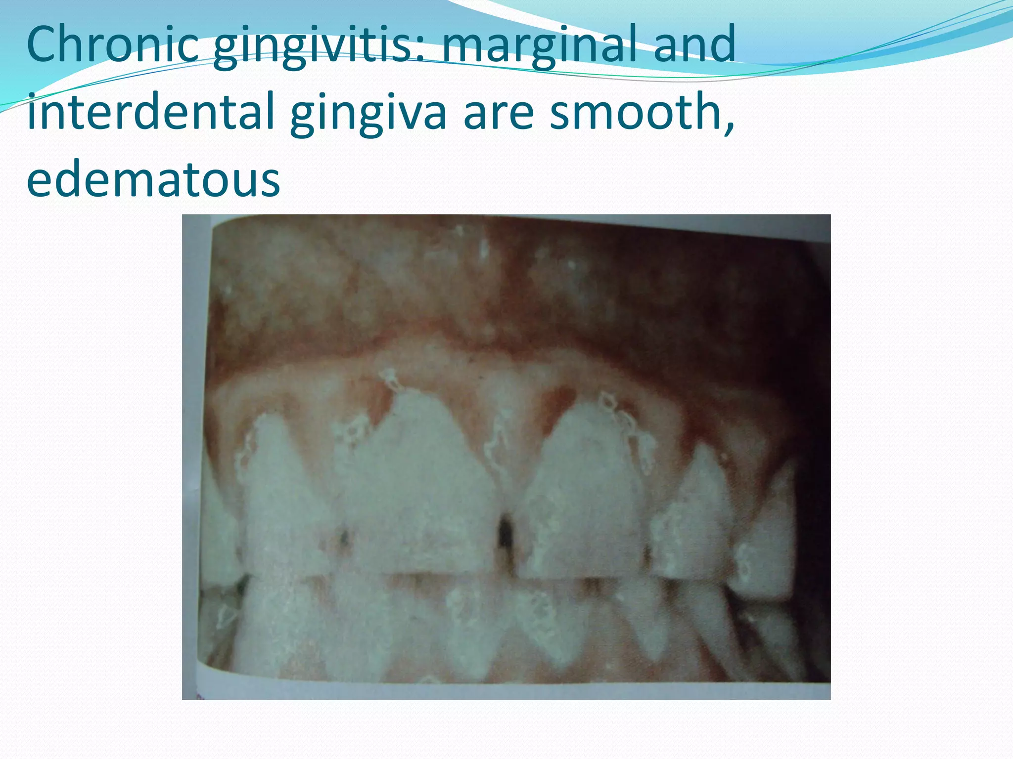 clinical features of gingivitis.pdf