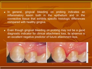 Clinical Features Of Gingivitis.ppt
