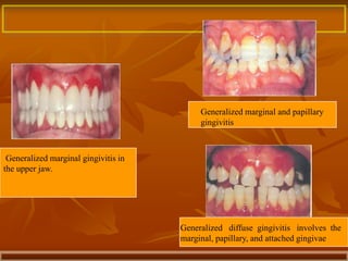 Clinical Features Of Gingivitis.ppt