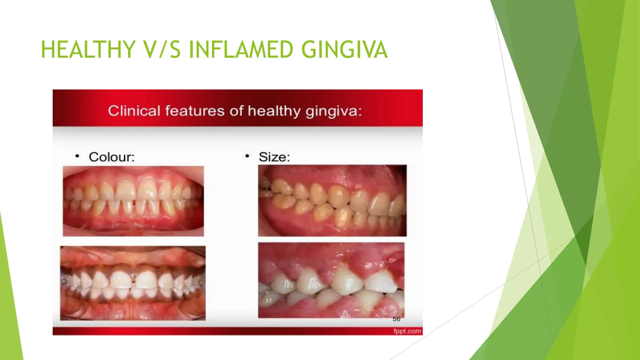 CLINICAL FEATURES OF GINGIVITIS Dental course | PPT