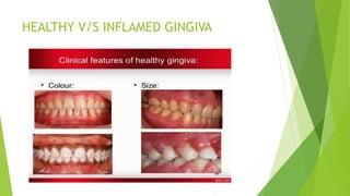 CLINICAL FEATURES OF GINGIVITIS Dental course | PPT