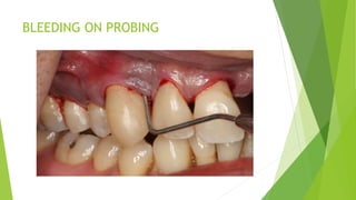 CLINICAL FEATURES OF GINGIVITIS Dental course | PPT