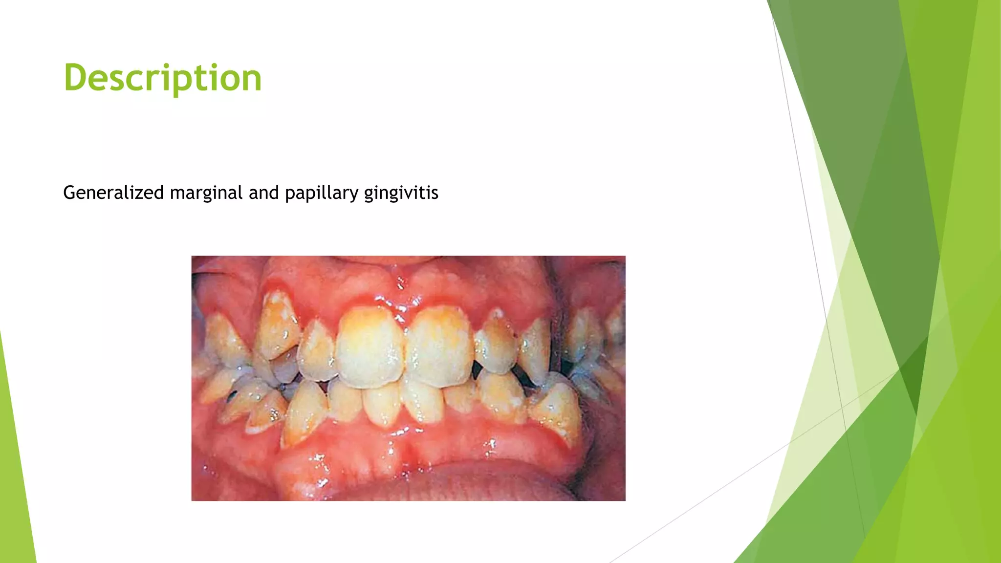 Clinical features of ginigvitis | PPTX