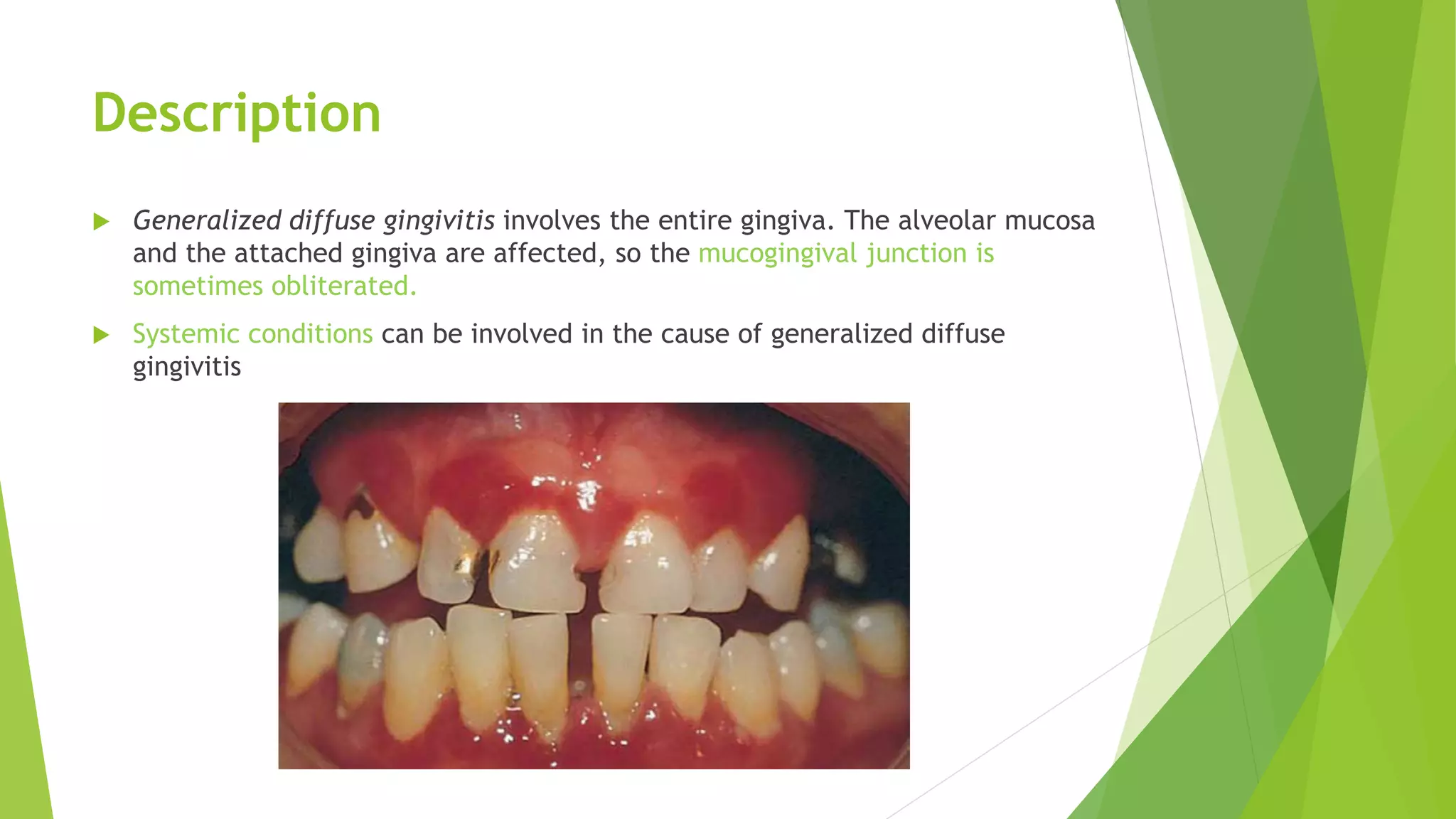 Clinical features of ginigvitis | PPTX