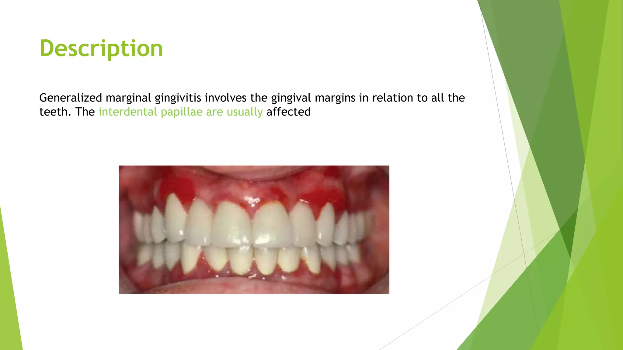 Clinical features of ginigvitis | PPTX