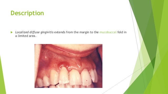 Clinical features of ginigvitis