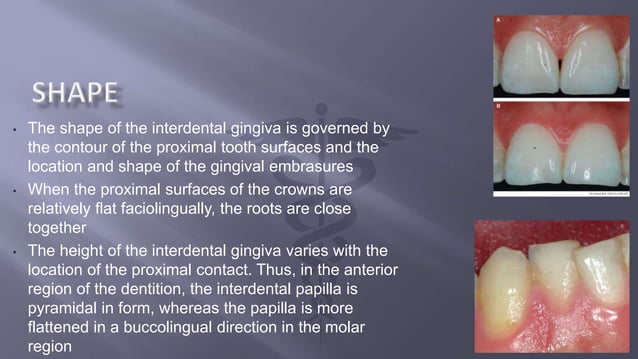 Clinical features of healthy gingiva | PPTX