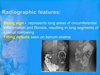 Inflammatory Bowel Disease Clinical features | PPTX