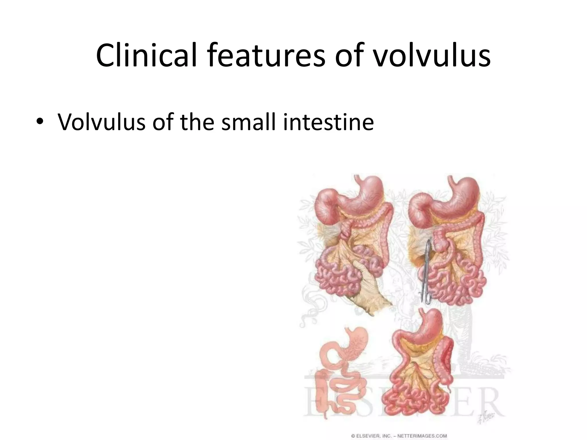Clinical features of intestinal obstruction | PPTX