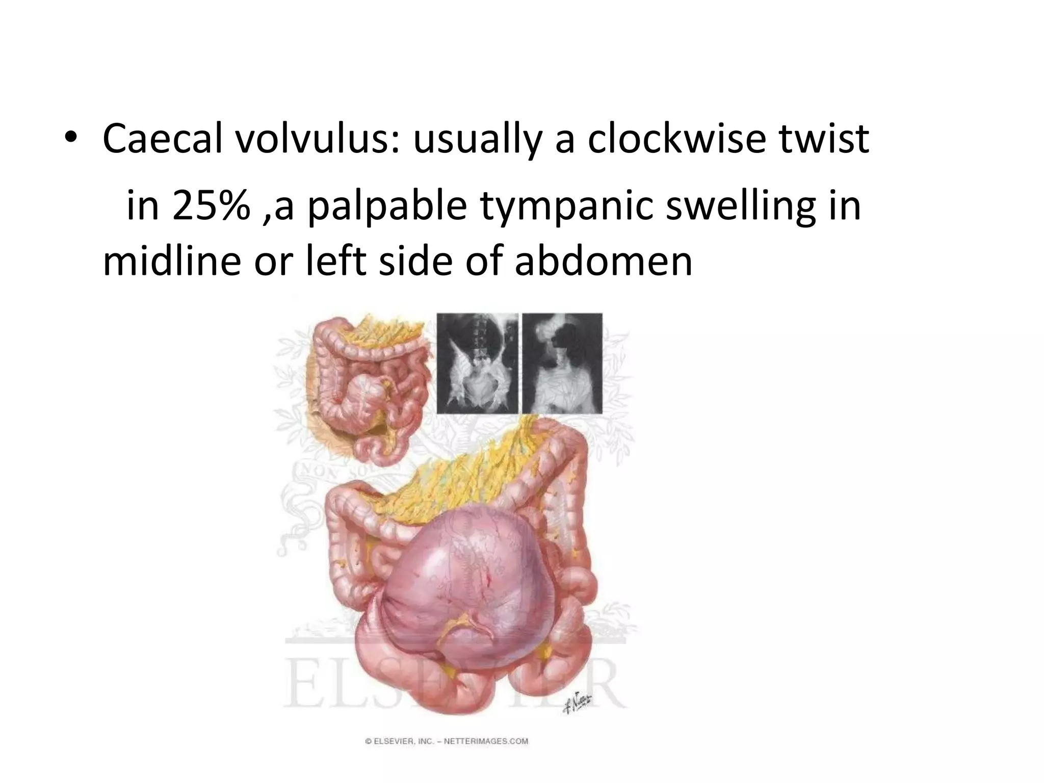 Clinical features of intestinal obstruction | PPTX