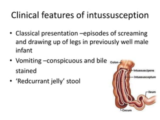 Clinical features of intestinal obstruction | PPTX