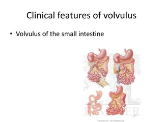 Clinical features of intestinal obstruction | PPTX
