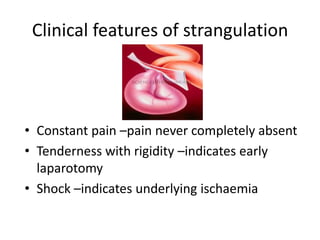 Clinical features of intestinal obstruction | PPTX