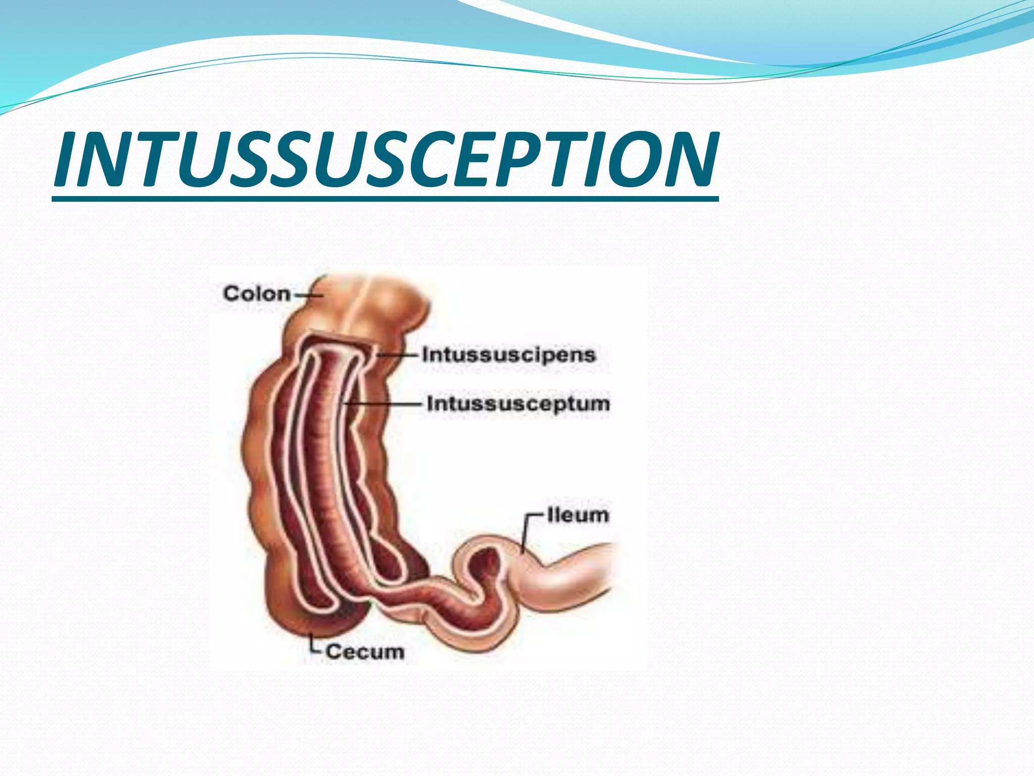 Clinical features of intestinal obstruction | PPTX