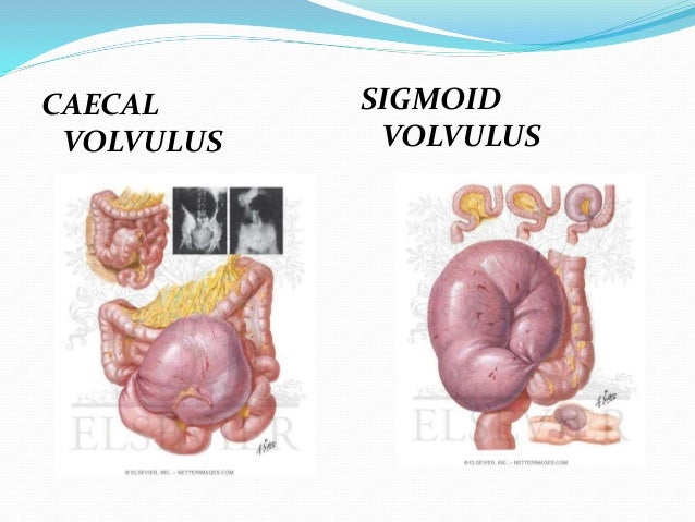 Clinical features of intestinal obstruction