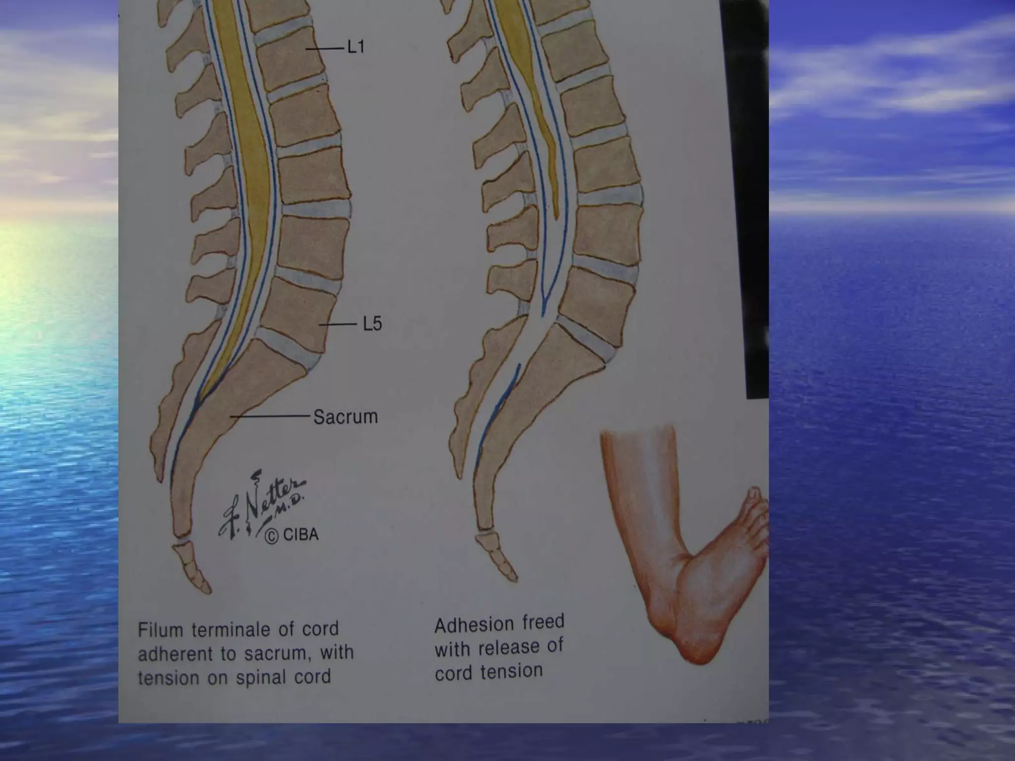 Clinical Features Of Neural Tube Defects | PPT