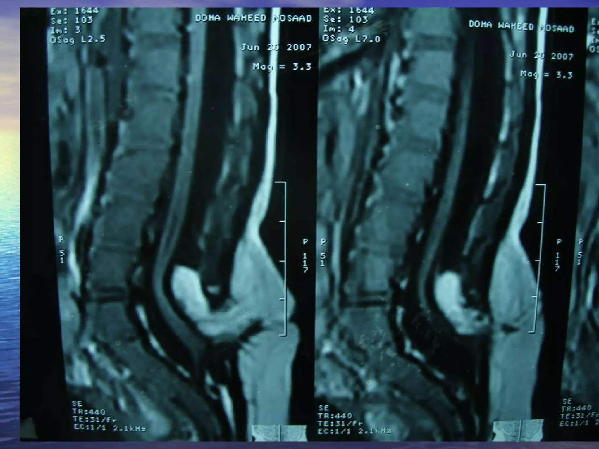 Clinical Features Of Neural Tube Defects | PPT