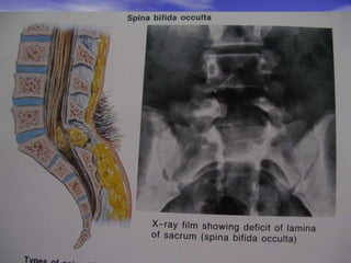 Clinical Features Of Neural Tube Defects | PPT