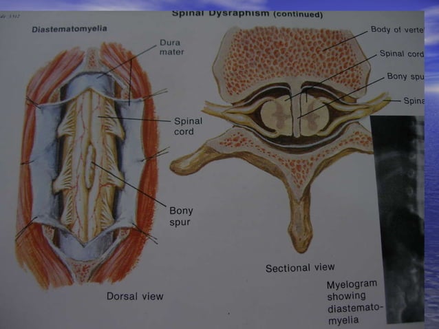 Clinical Features Of Neural Tube Defects | PPT