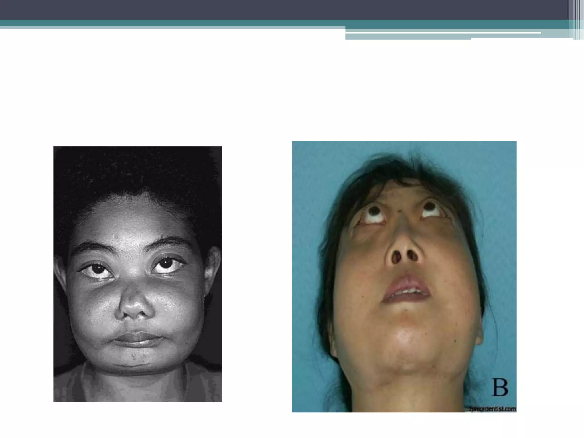 Clinical features of premature exfoliation | PPTX