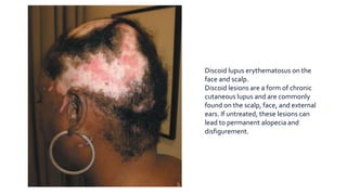 Clinical features of systemic lupus erythematosus | PPTX