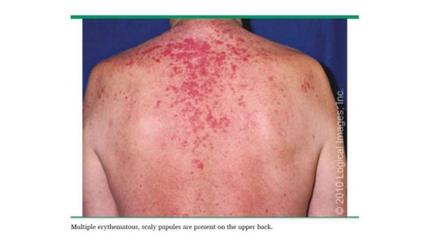 Bullous Leukocytoclastic Vasculitis