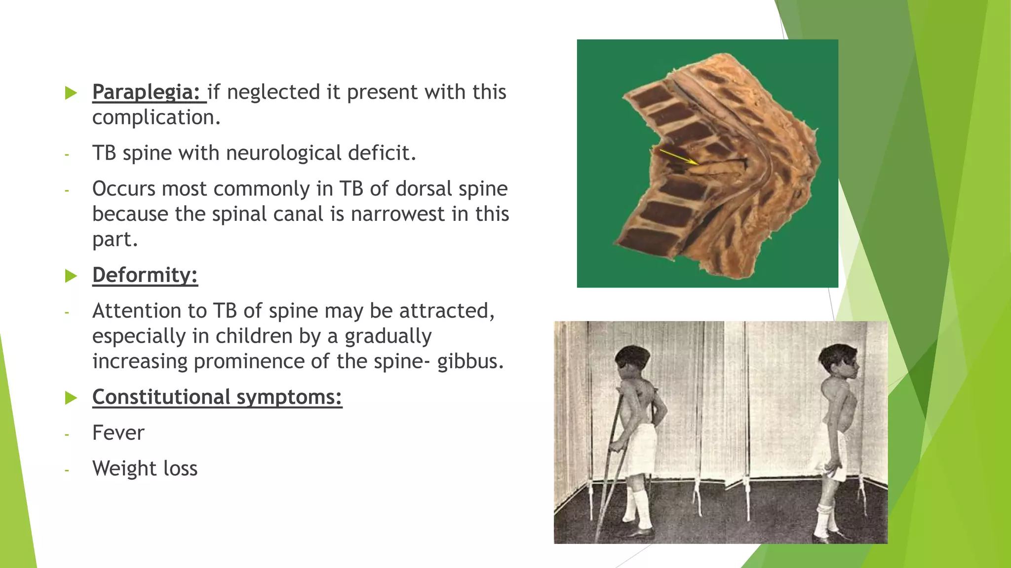 Clinical Features of TB Spine | PPTX