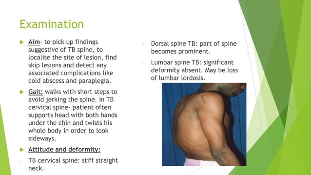 Clinical Features of TB Spine | PPT