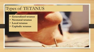 Clinical features of tetanus | PPTX