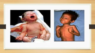 Clinical features of tetanus | PPTX