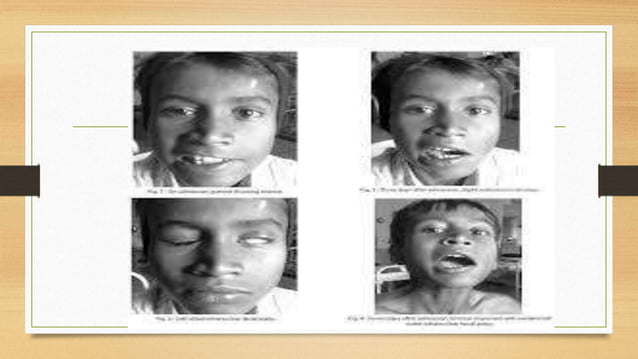 Clinical features of tetanus | PPTX