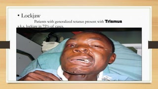 Clinical features of tetanus | PPTX