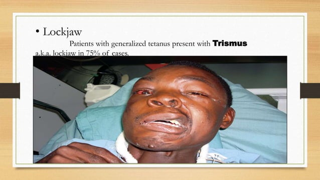 Clinical features of tetanus | PPTX