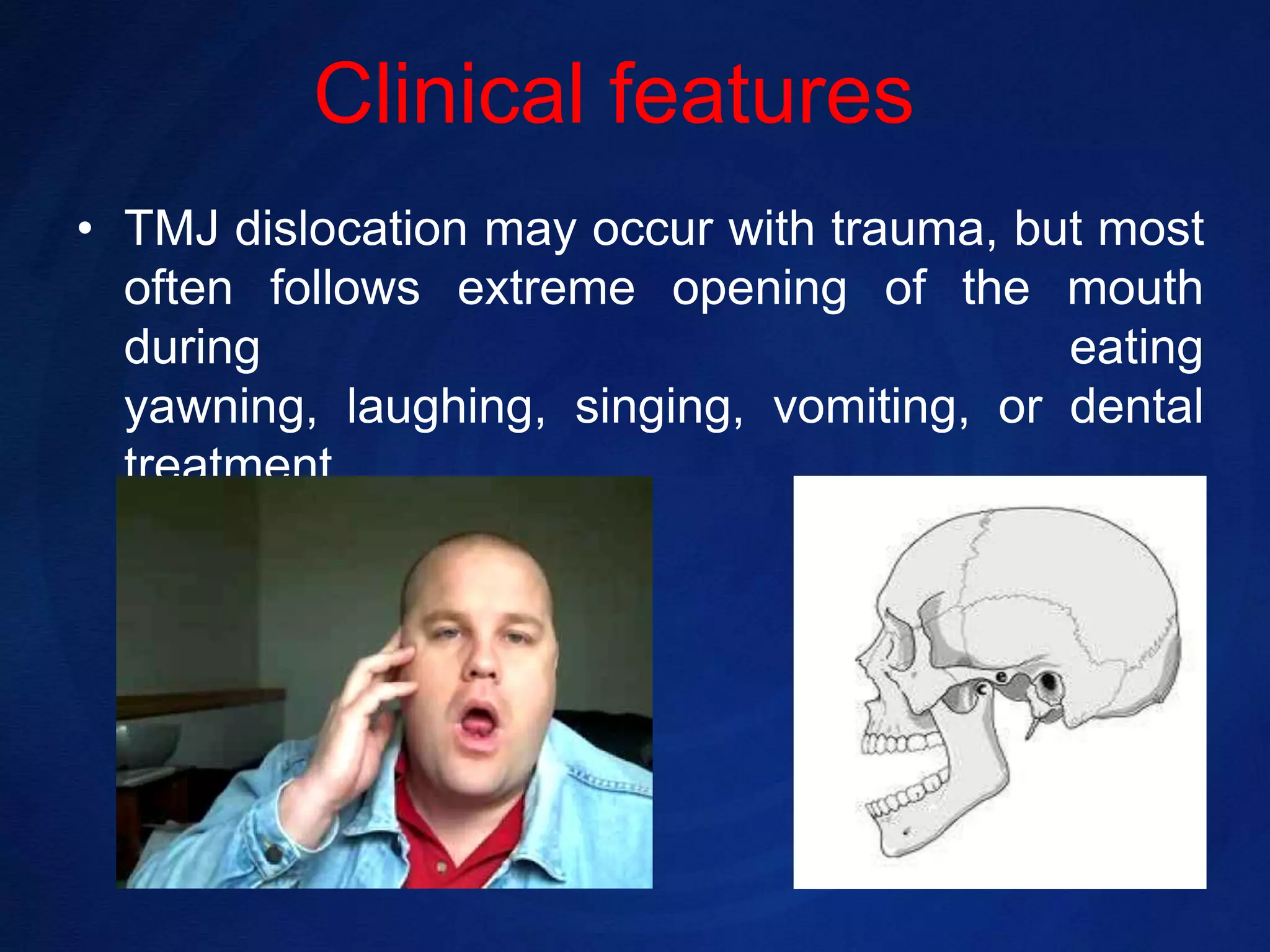 Clinical features of tmj dislocation | PPT