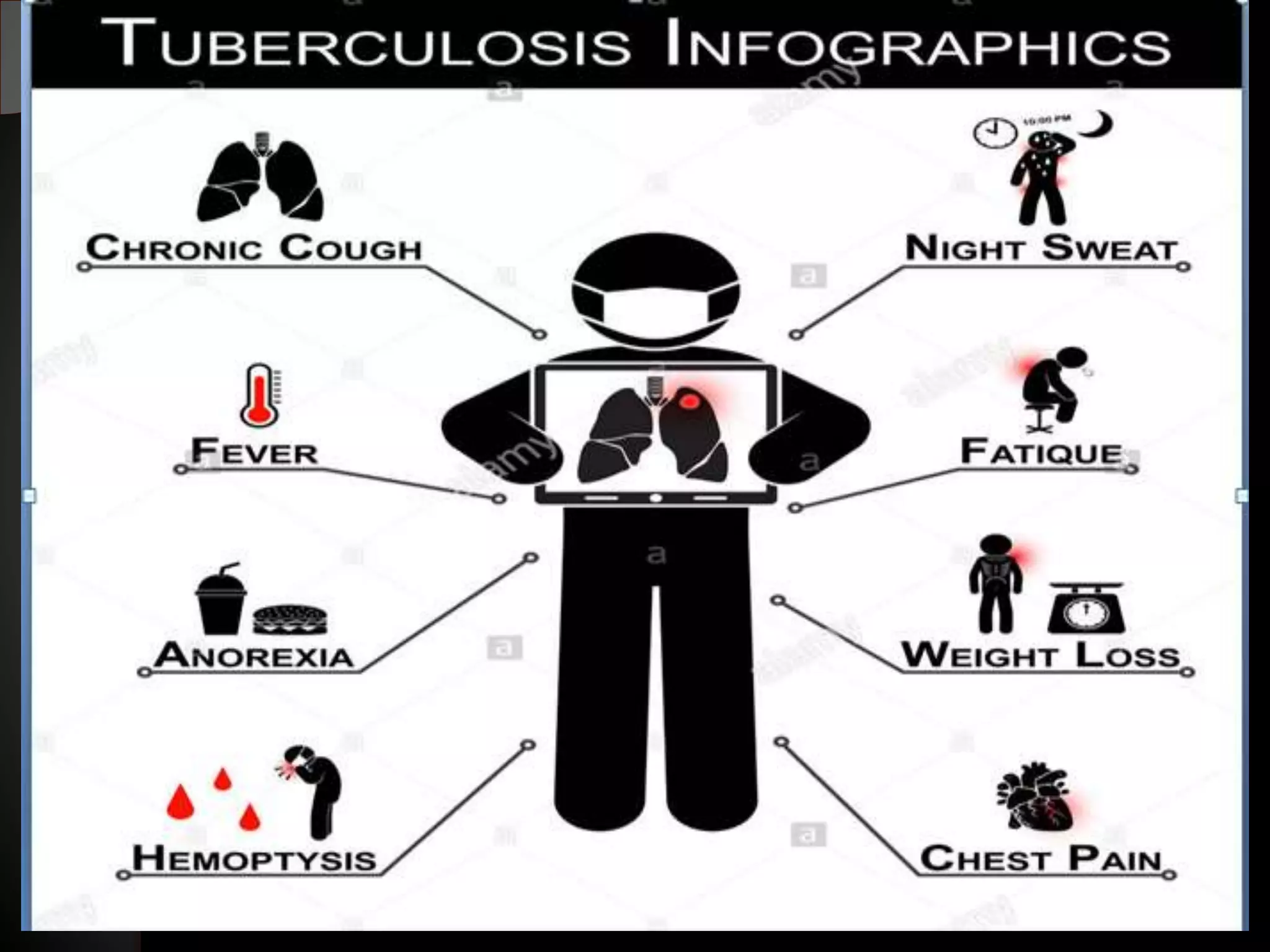 Clinical features investigation of pulmonary tb | PPT